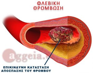 Φλεβική θρόμβωση | Aggeia.eu